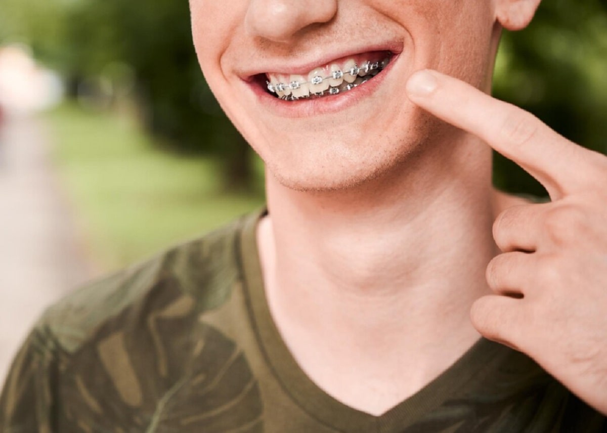 Metal Diş Teli - Ortodontist Dr. Yasin Akgül